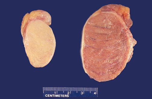 Male Genital Pathology