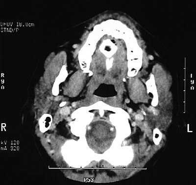 Normal Neck Ct Scan