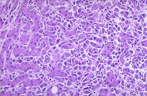 Hepatocellular Carcinoma Histology