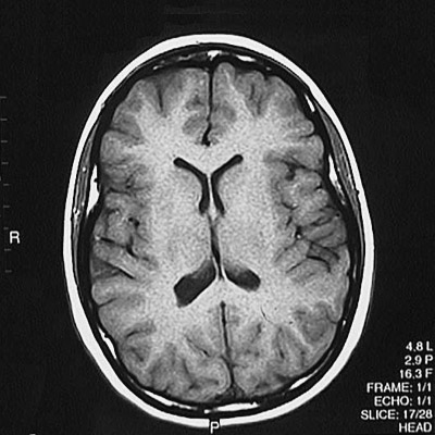 MRI, Axial T1 Weighted