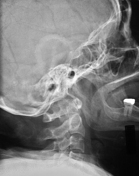 Mastoid Air Cells X Ray