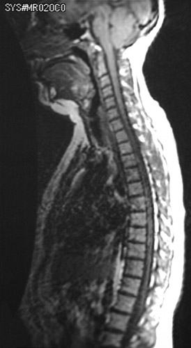 Normal Thoracic Spine Mri